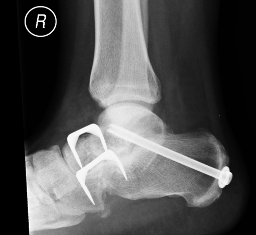 Surgery for Tibialis Posterior Tendinopathy - David Shepherd